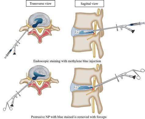 Microdiscectomy Scar