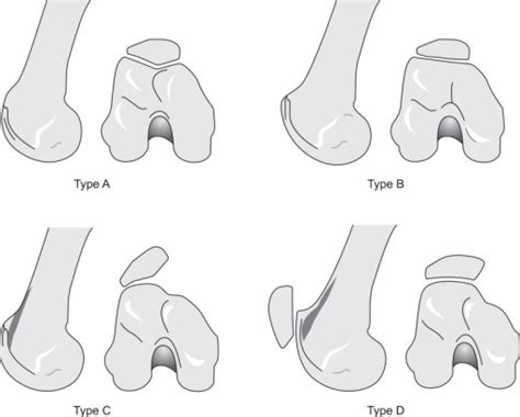 Dejours Classification Of Trochlear Dysplasia Type A Crossing Sign