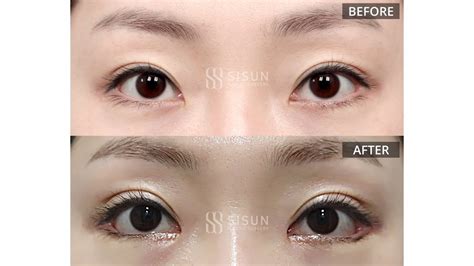 무보정전후영상 풀트임 반달눈성형 자연유착매몰 쌍꺼풀 재수술앞트임윗트임뒤트임재수술밑트임재수술5주 Youtube