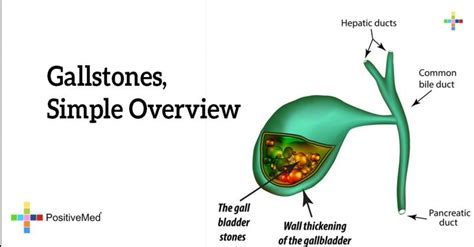 Gallstones Simple Overview