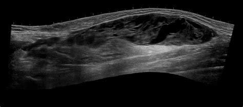 Ultrasound Case 098 • Litfl • Pocus Self Assessment Quiz