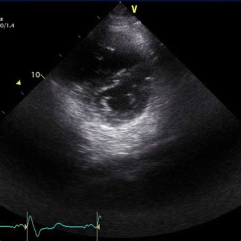 Constrictive Pericarditis Following Correction Of Partial Anomalous Pulmonary Venous Drainage