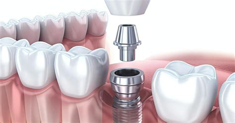 Prettiva Clinic Whats The Most Common Cause Of Implant Failure