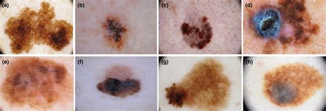 Melanoma Dermoscopy