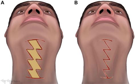 Direct Neck Lift For Men Facial Plastic Surgery Clinics