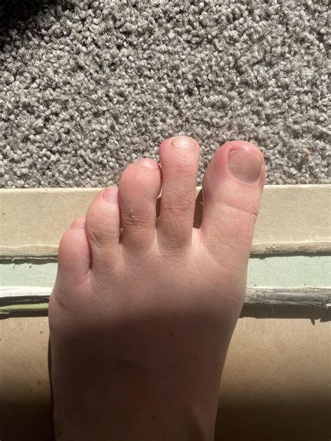 Itchy And Swollen Toes Rdermatologyquestions