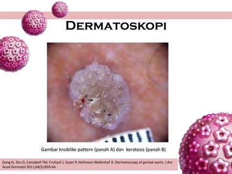 Presentation Kondiloma Akuminata Pdf