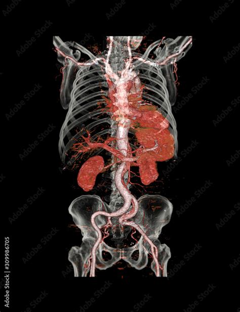 CTA Abdominal Aorta 3D Rendering Image Showing Aortic Dissection With