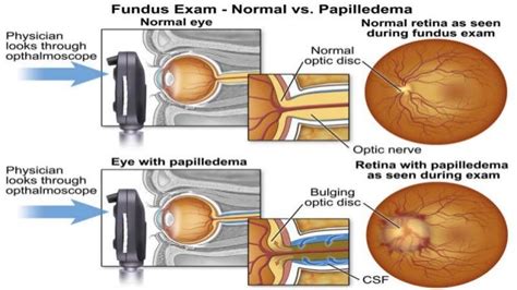 Papilledema Vs Papillitis Papilledema Swollen Optic Nerve Is It An