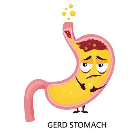 Enfermedad Por Reflujo Gastroesofágico Erge Y Acidez Estomacal Ilustración Con Personaje De