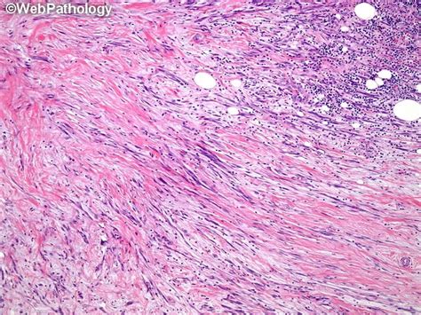 Desmoplastic Melanoma