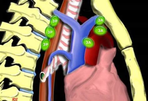 Mediastinal Lymph Node Levels