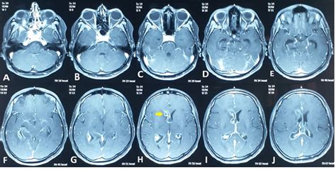 Paradoxical Presentation In A Case Of Deep Frontal Lobe Abscess
