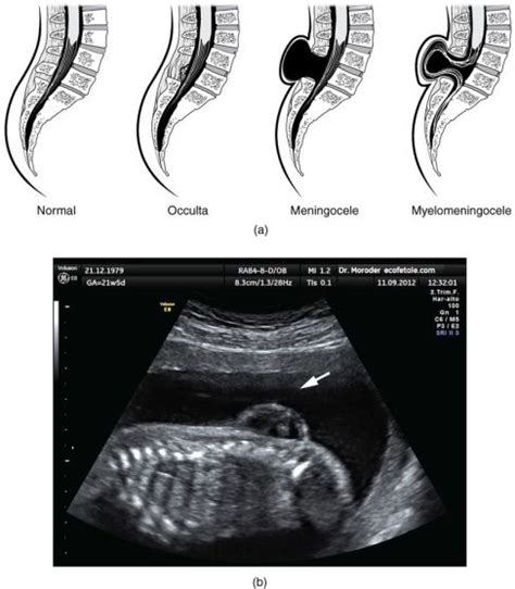 Meningocele