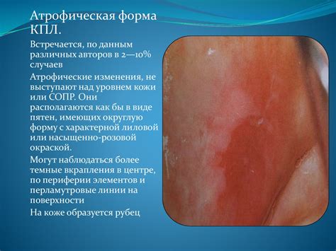 5 Лекция псориаз красный плоский лишай презентация онлайн