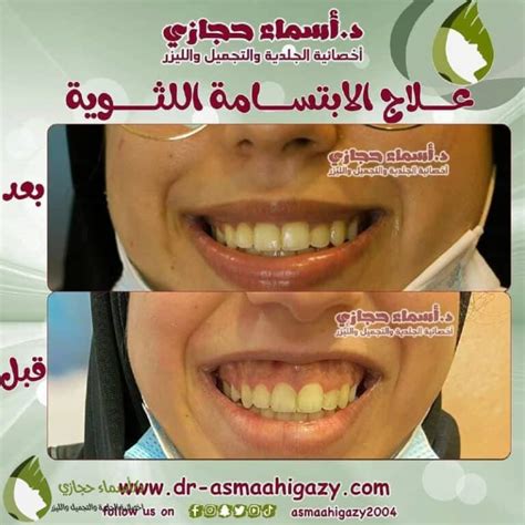 حقن البوتكس ما هو و ما إستخداماته وأنواعه و متى تظهر النتائج 2024