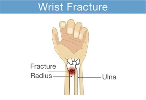 Different Types Of Distal Radius Fractures Seen In The Hand Therapy Clinic