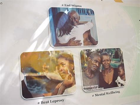 National Leprosy Program Bemoans Stigmatization Against Cured Lepers