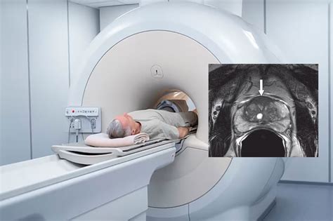 Mri Guided Prostate Cancer Detection A Breakthrough In Mens Health