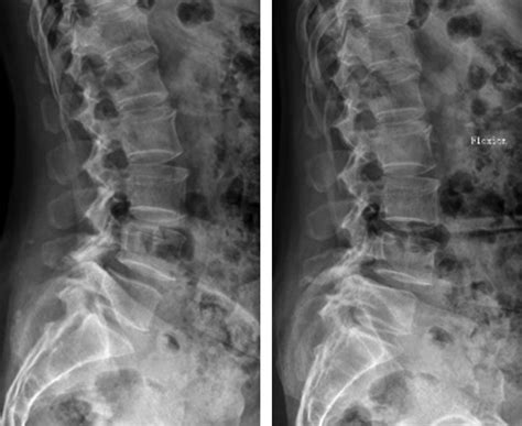 Frontiers Case Report Surgical Treatment Of Lumbar Ligamentum Flavum