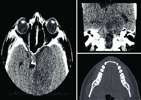 Diagnostic Computed Tomography Maxillofacial Images Figure Description