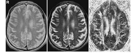 Typical Proton Density Weighted Left T 2 Weighted Center And