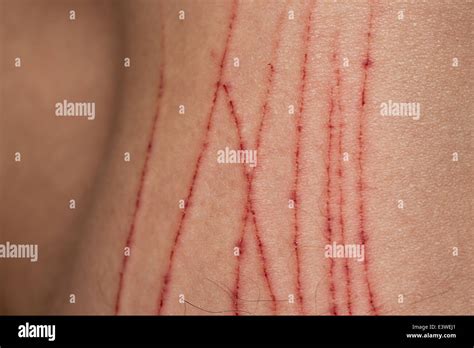 Scratches On Skin