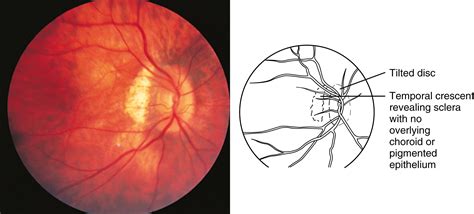 Ophthalmology Clinical Tree