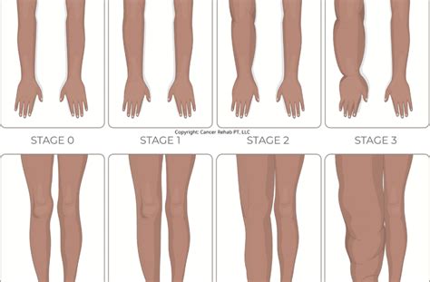 Lipedema Vs Lymphedema Whats The Difference And What To Do Cancer