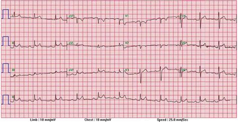 Lead EKG Demonstrating Diffuse ST Elevations Download Scientific