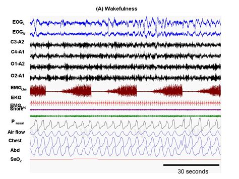 Polysomnography Monitoring Sleep Somnography