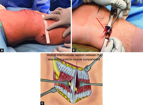 Deep Peroneal Nerve Decompression