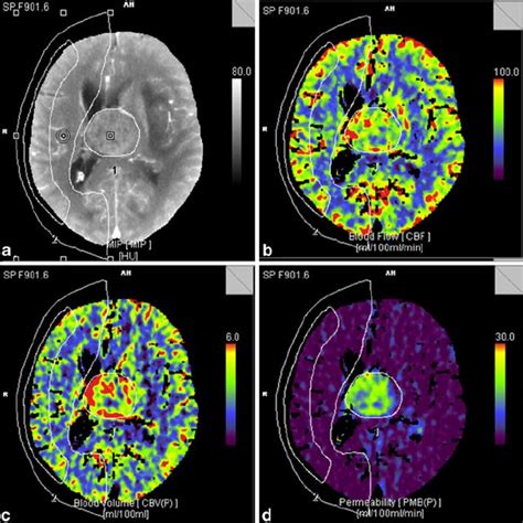Pdf Dynamic Ct Perfusion Imaging Of Intra Axial Brain Tumours Differentiation Of High Grade