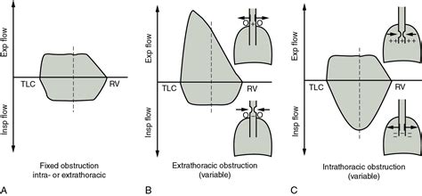 Anesthetic Considerations For Obstructive Lung Disease Clinical Tree