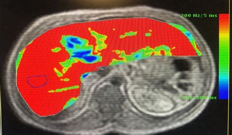 T2 Mapping Mri Farsi