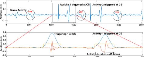 Figure 1 From Locating Regions Of Arrhythmogenic Substrate By Analyzing The Duration Of