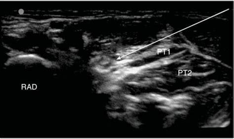 Median Nerve At The Pronator Teres Injection Wikism Sports Medicine