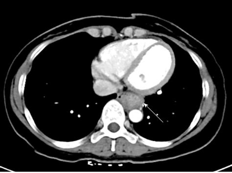 Thoracic Contrast Enhanced Computed Tomography An Enhancing Mass Download Scientific Diagram