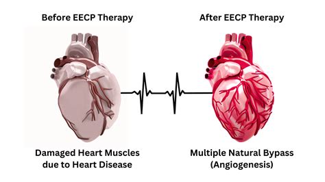Eecp Therapy Centre For Optimum Health