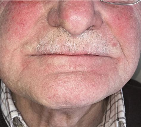 Recouvrement Antérieur Et Abrasions Sévères Traitement Par Prothèse