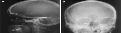 Temporary Balloon Occlusion Of The Cavernous Carotid Artery Neurosurgery