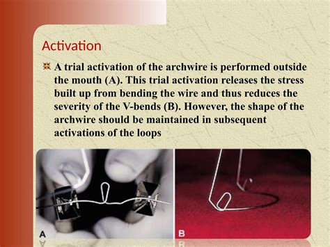 Loops In Orthodontics And Its Uses Autosaved Ppt