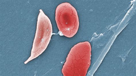 Nhlbi Research Grants Advance Sickle Cell Treatment From Lab To