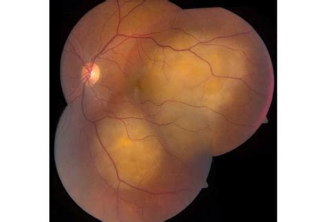 Choroidal Metastasis Wills Eye Hospital