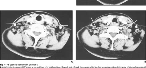Figure 7 From Imaging Based Nodal Classification For Evaluation Of Neck Metastatic Adenopathy