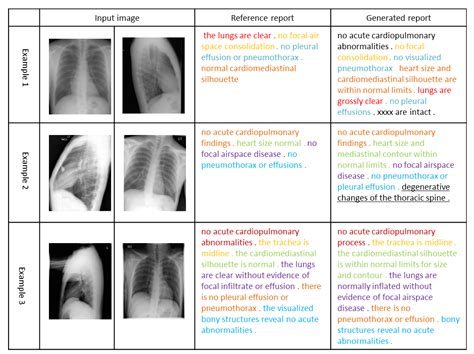 Normal Chest X Ray Radiology Report At Debra Covington Blog