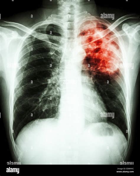 Pulmonary Tuberculosis TB Chest X Ray Show Alveolar 48 OFF