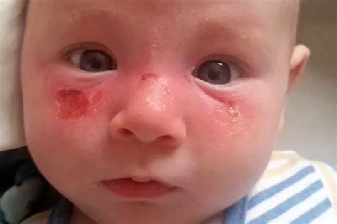 Sun Blisters On Face