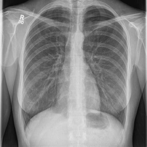 Patients Chest Radiograph Interpreted As Showing No Abnormality