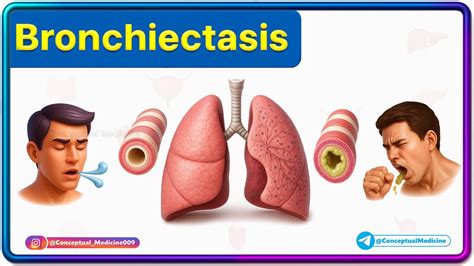 4 Bronchiectasis 🫁 Causes Hrct Signs And Management Simplified Neet Pg Usmle Fmge High